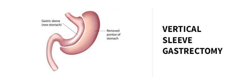Stomach Stapling - What is it?